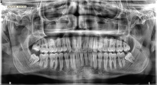 Wisdom Teeth Removal | RI Oral Surgery & Implant Center