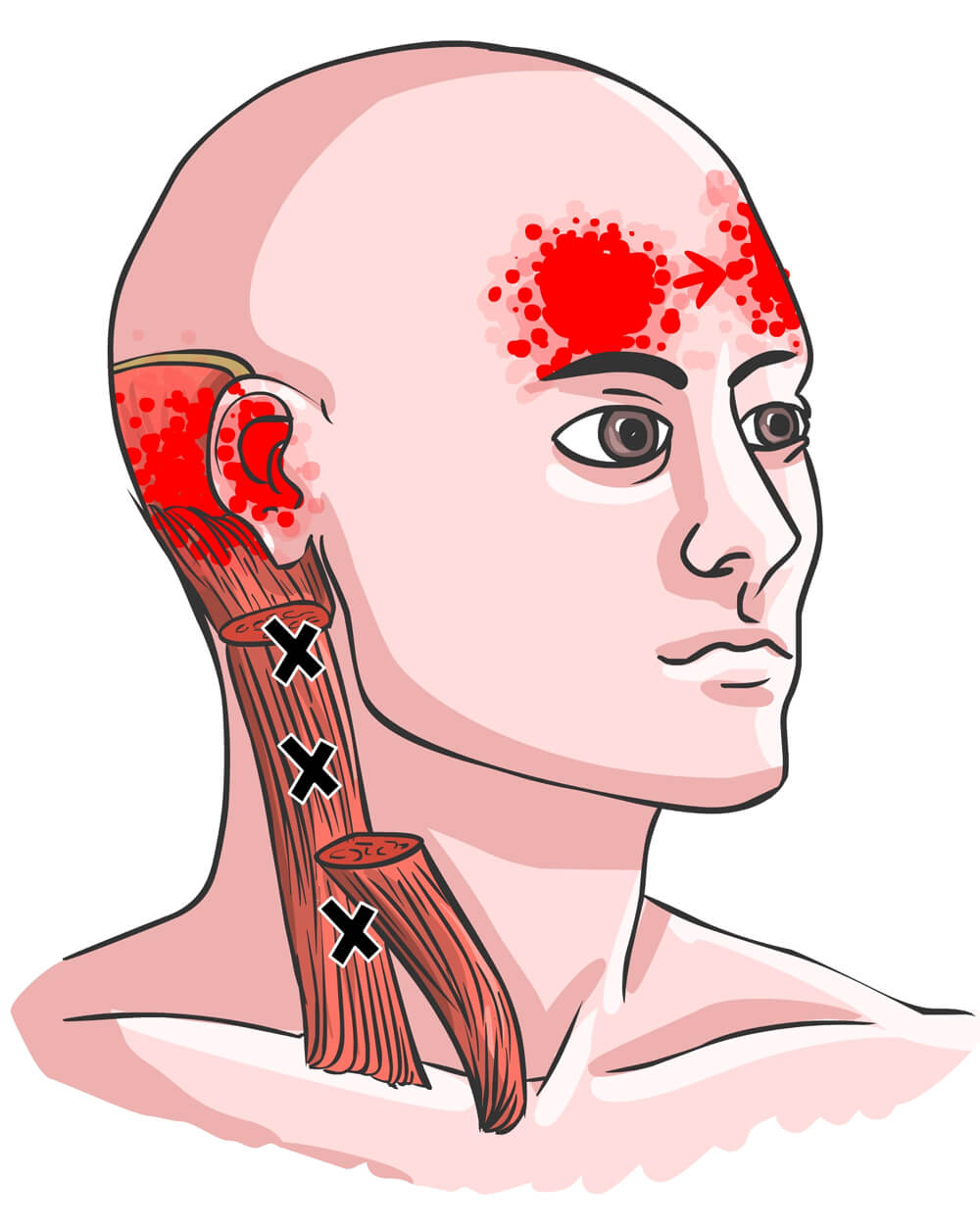 RBM Exclusive | Sternocleidomastoïdeus of borstbeen-sleutelbeen-tepelspier