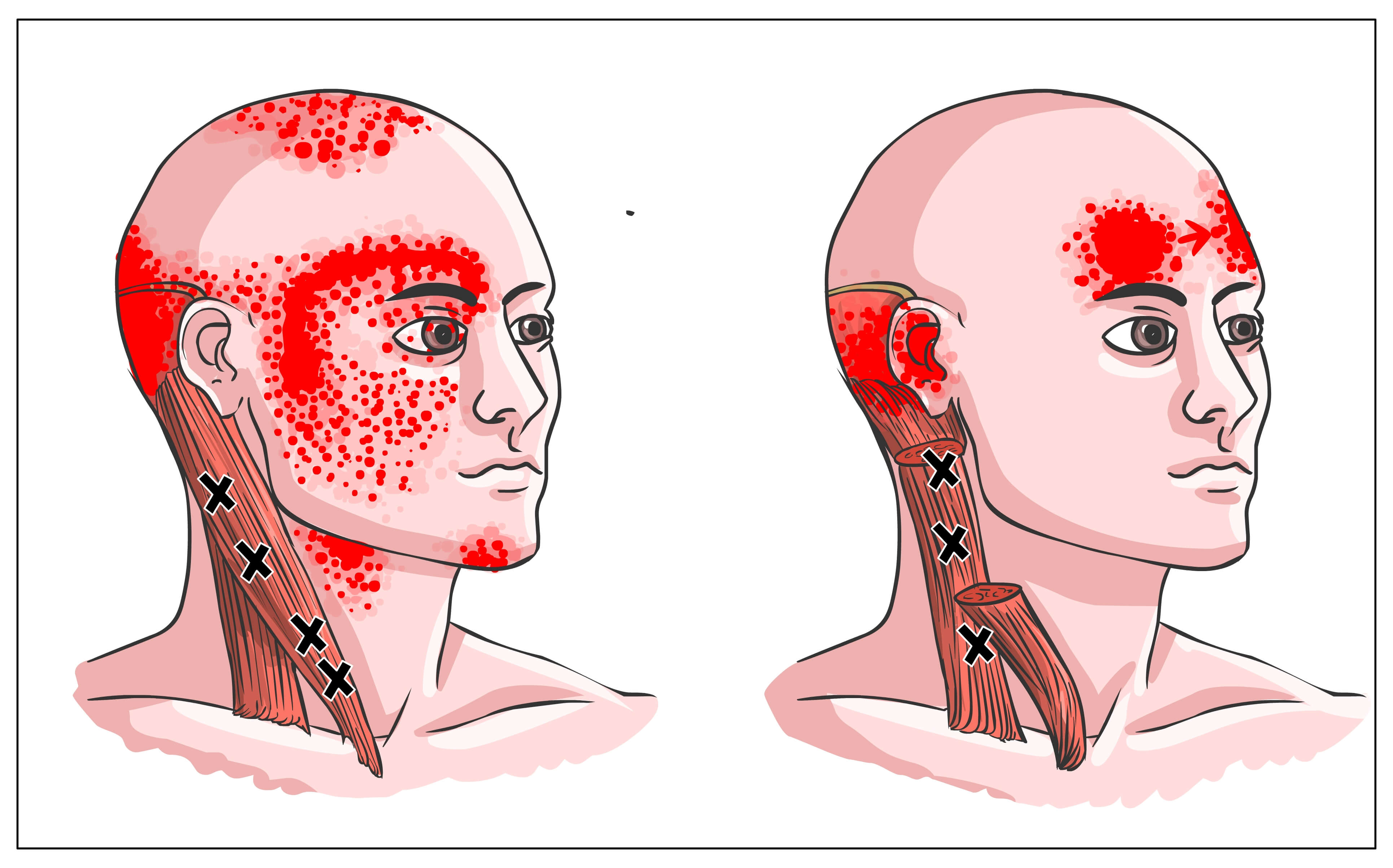 RBM Exclusive | Sternocleidomastoïdeus of borstbeen-sleutelbeen-tepelspier