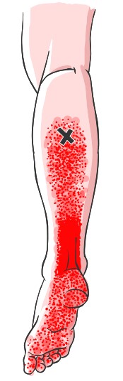 RBM Exclusive | Tibialis Posterior of Achterste Scheenbeenspier