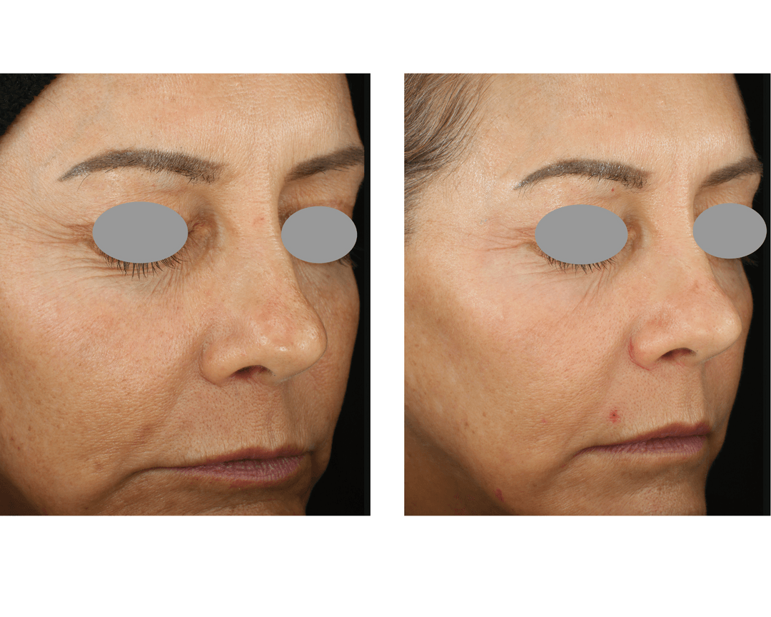 Tixel® AOB Med Spa Denver