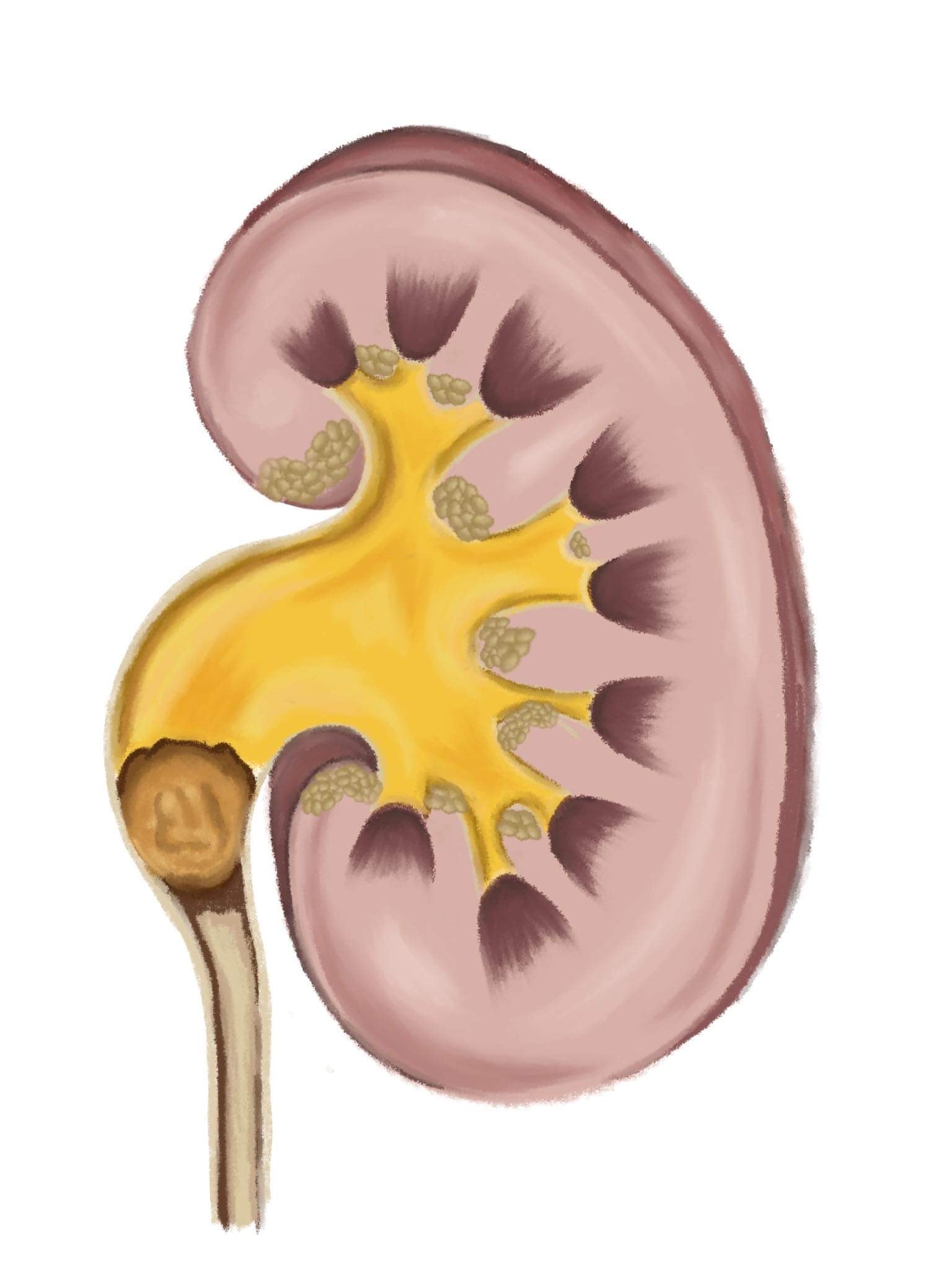 Kidney Stones Hobart | Davies Urology