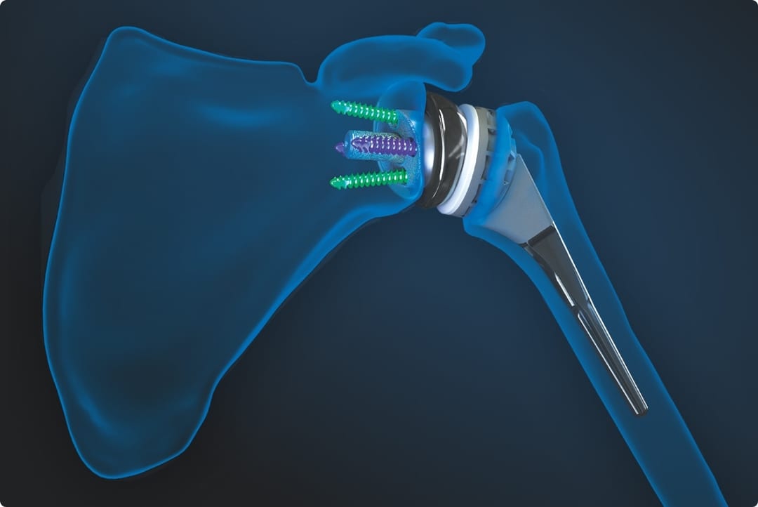 Arthrex Arthroplasty