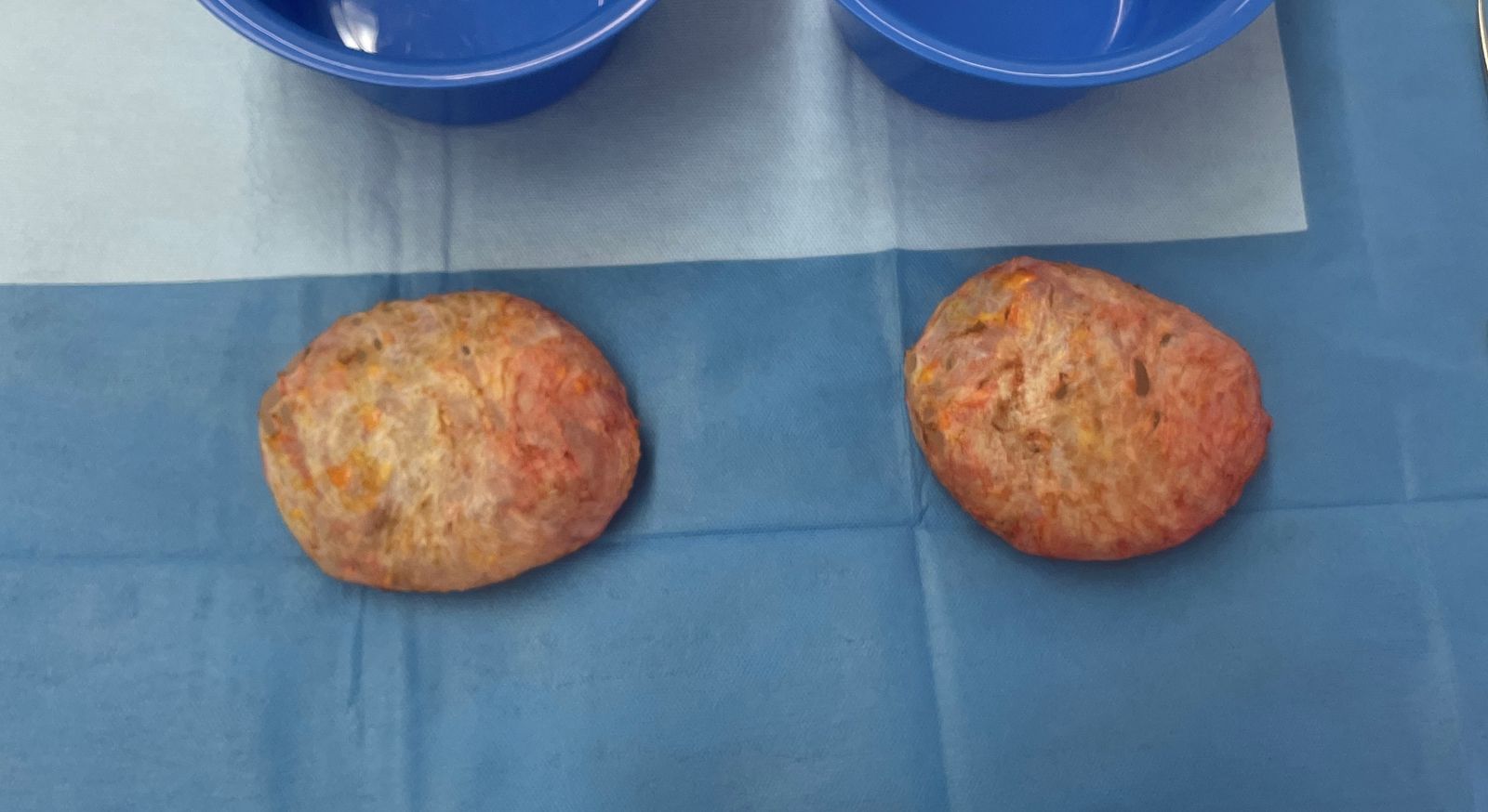 Aesthetic expectations after explant surgery?