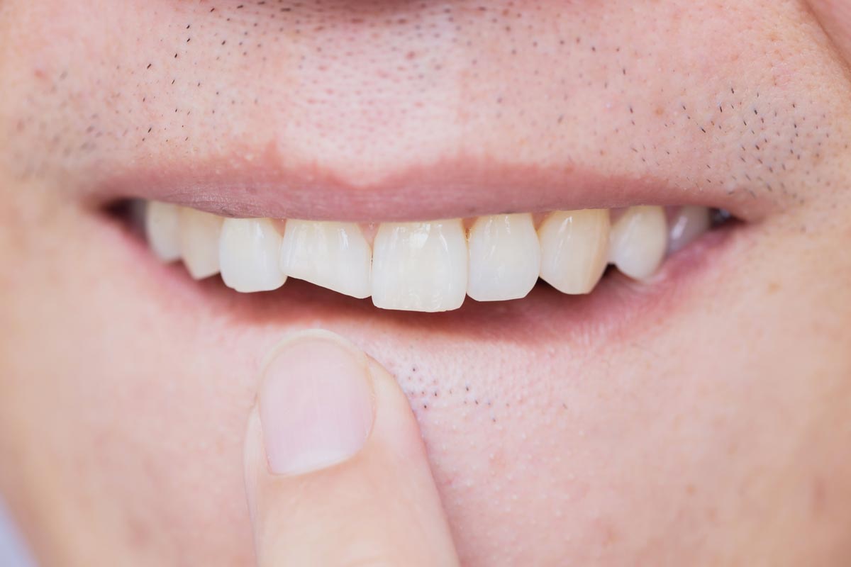 Bonding Smalltown Dental Bonding Smalltown Dental
