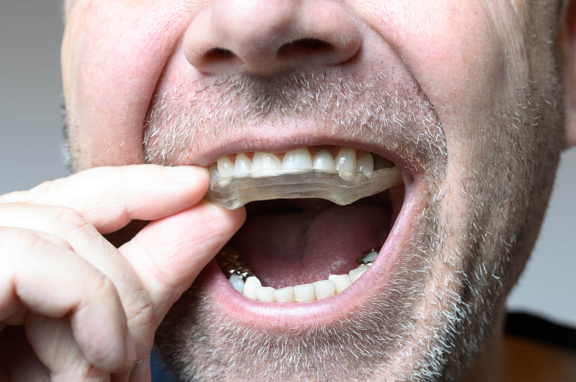 Oral Health Effects of Teeth Grinding