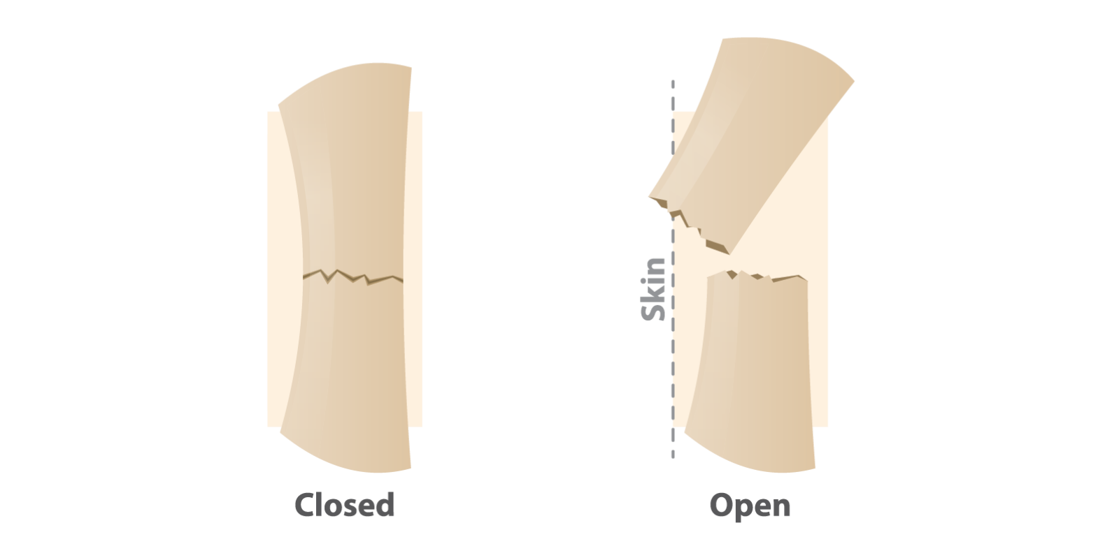 Open Vs Closed Fracture