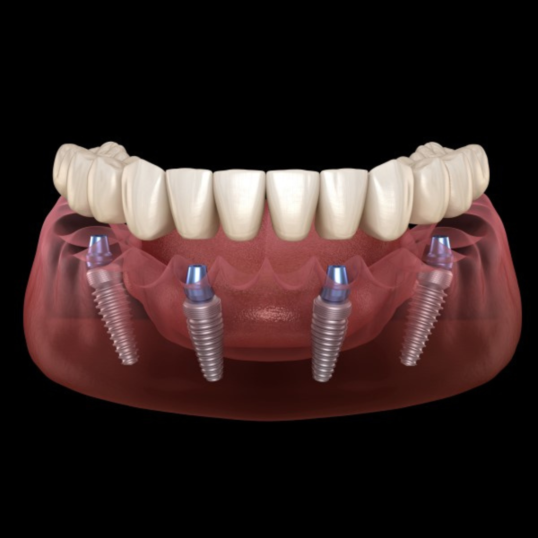 Implant Retained Denture