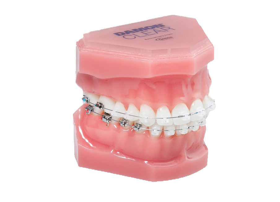Fixed Appliances | The Orthodontic Practice, Liverpool