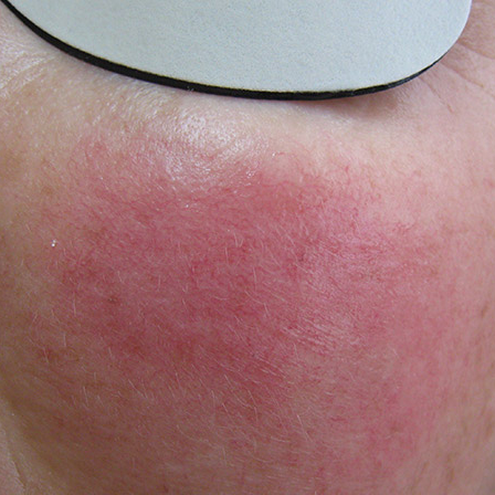 Redness Treatments | Rejuv Skin & Laser Clinic