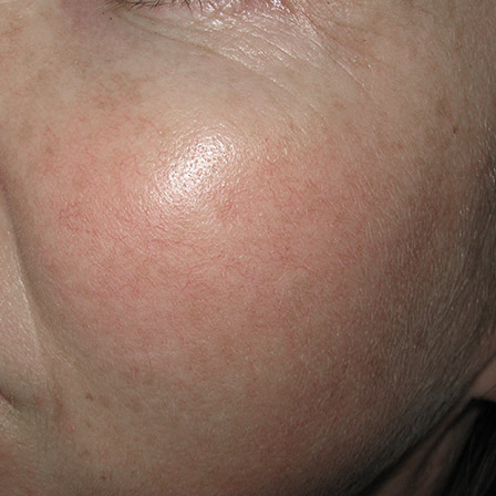 Redness Treatments | Rejuv Skin & Laser Clinic