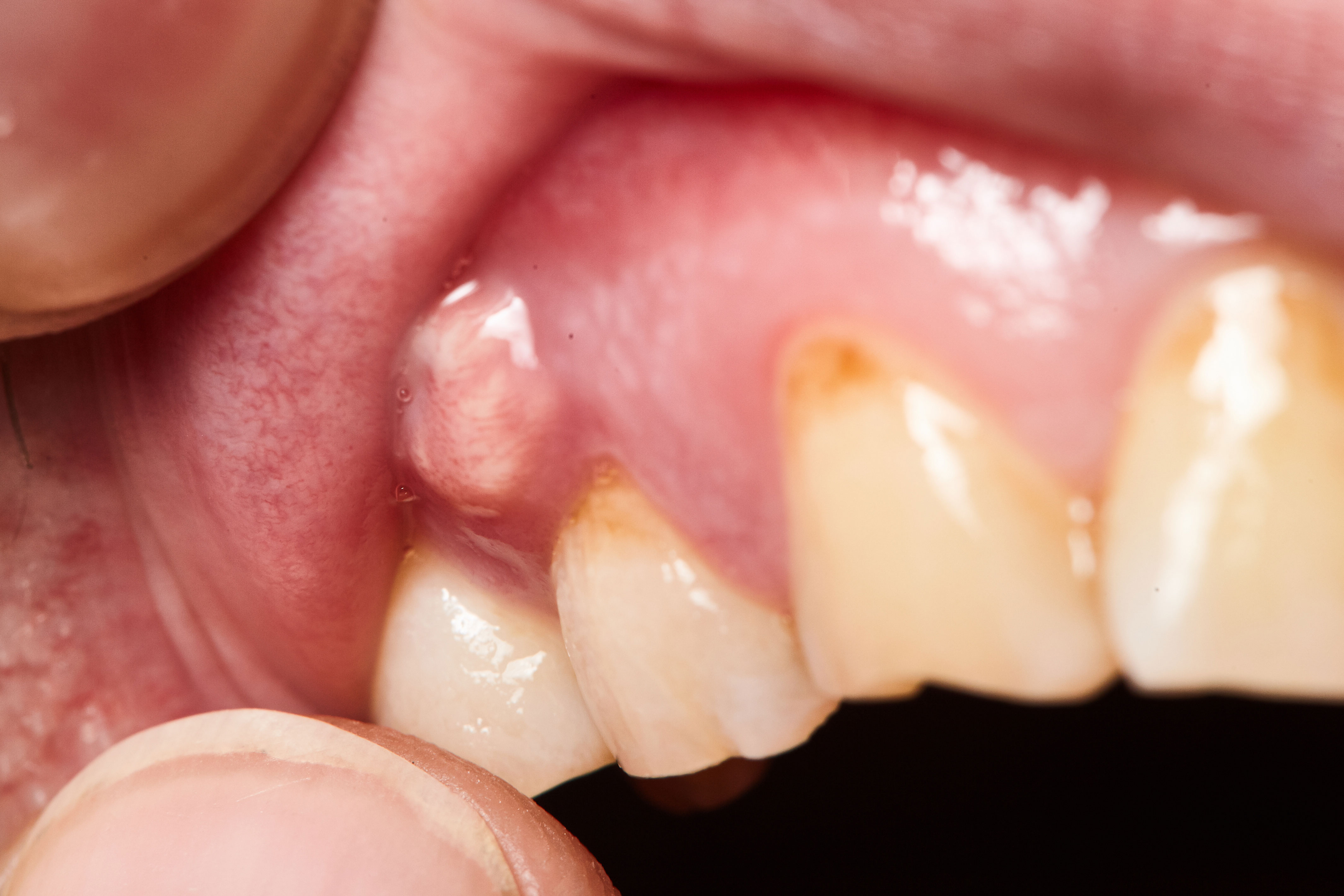 Incision And Drainage In McAllen TX Swift Dental PA Incision And Drainage In McAllen TX Swift Dental PA