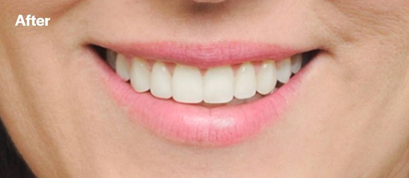 Damon Braces in Caldwell & Middleton, ID | Clock Tower Orthodontics