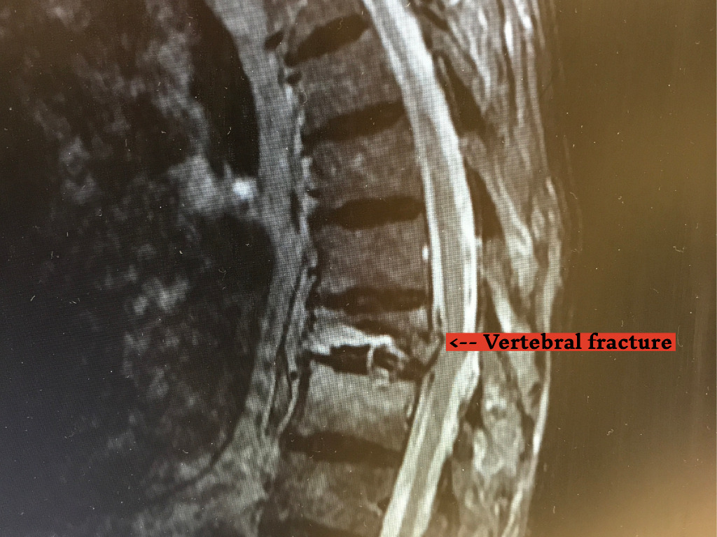 Trait: Bone mineral density (VDR) | FitnessGenes®