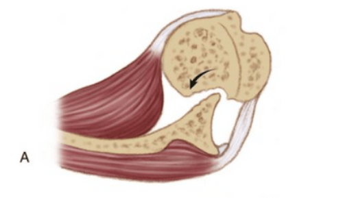 What is a Remplissage for shoulder dislocations? - Client First Wireframe 5