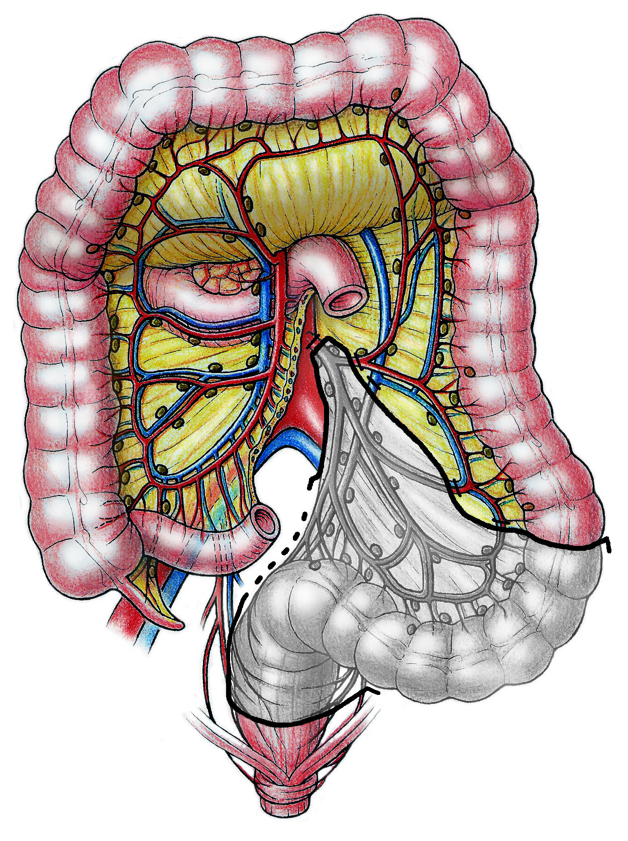 VISCERA – Operationen – Enddarmentfernung (Rektumresektion)