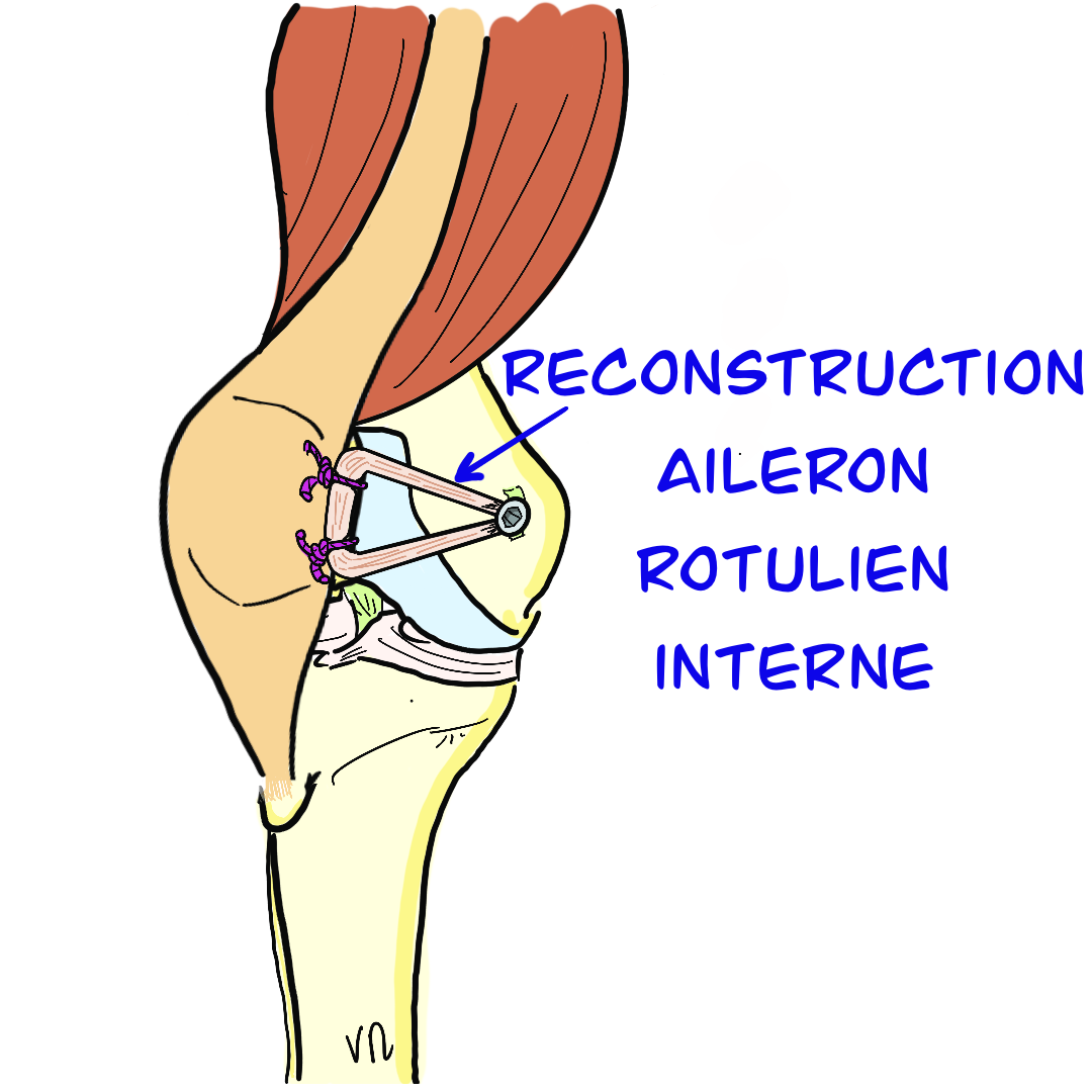 Patella stabilization - Professor Etienne Cavaignac - Orthopaedic ...