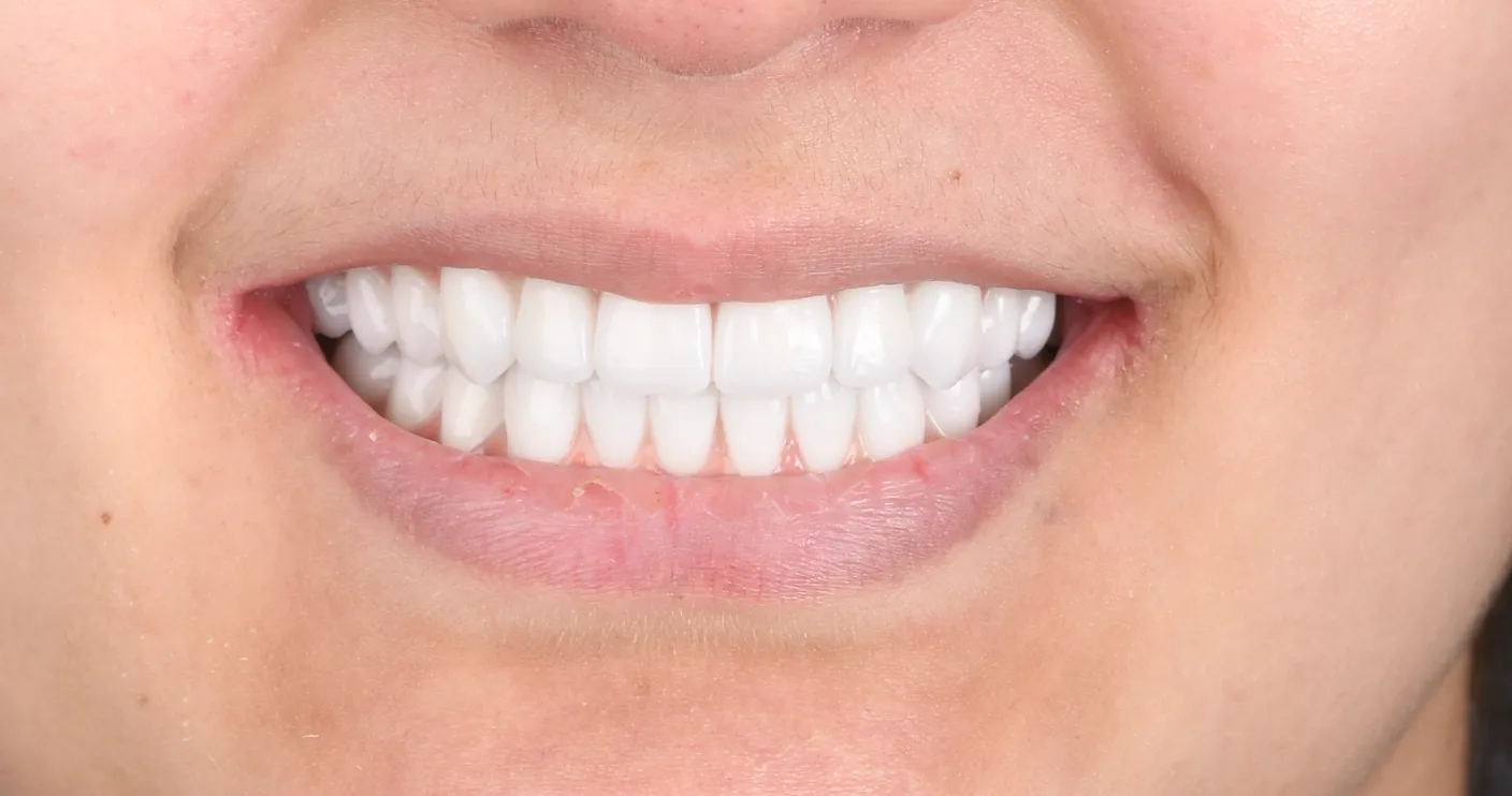 Dental Implant Smile Transformations