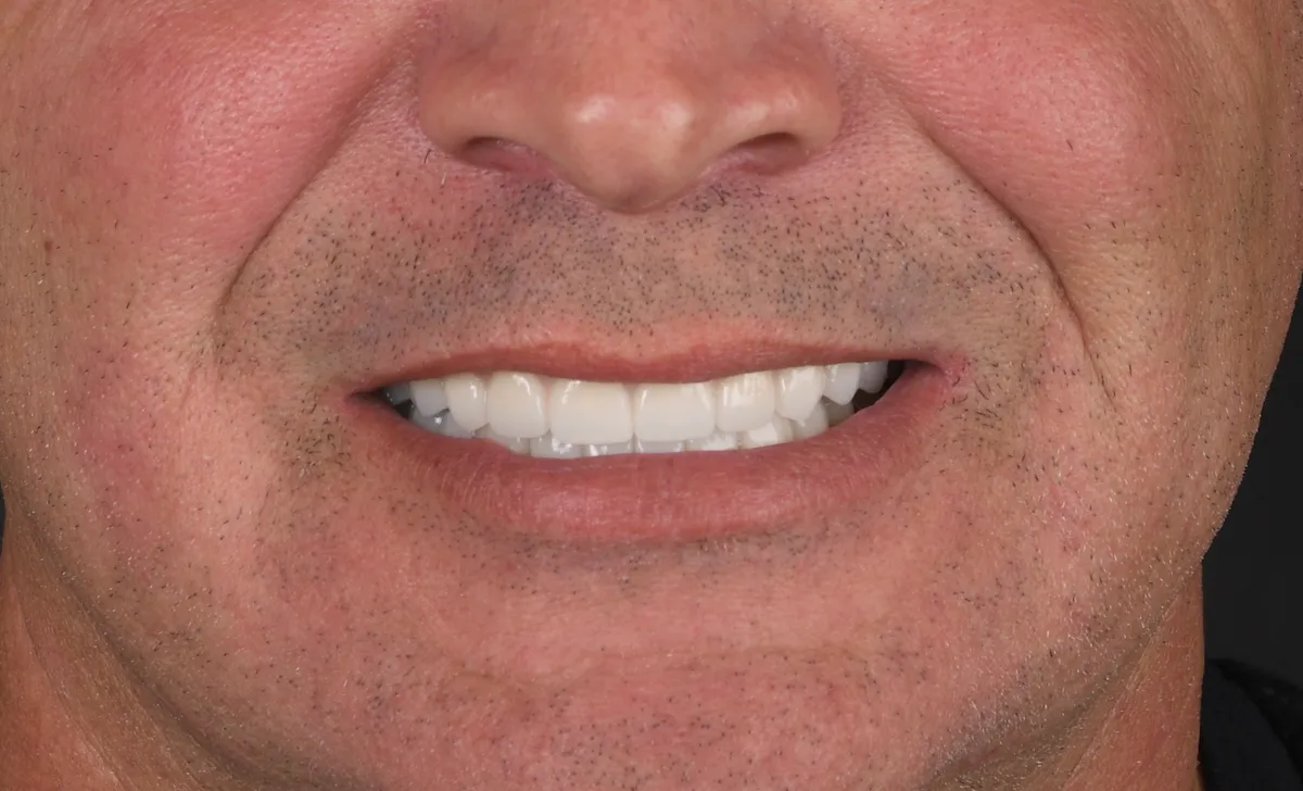 Dental Implant Smile Transformations