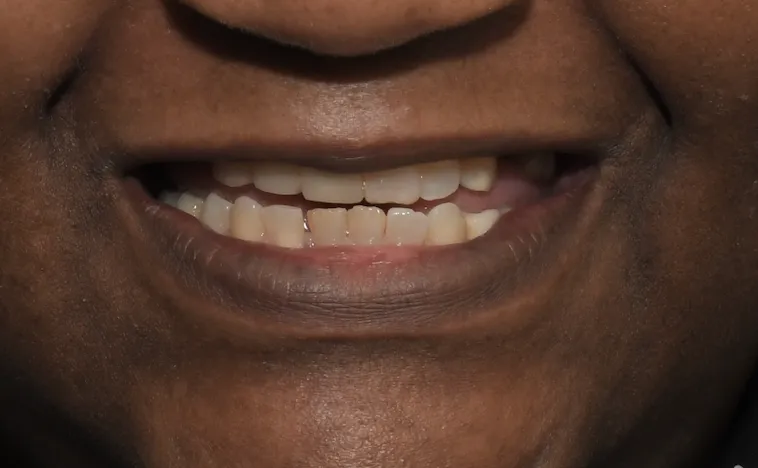 Dental Implant Smile Transformations