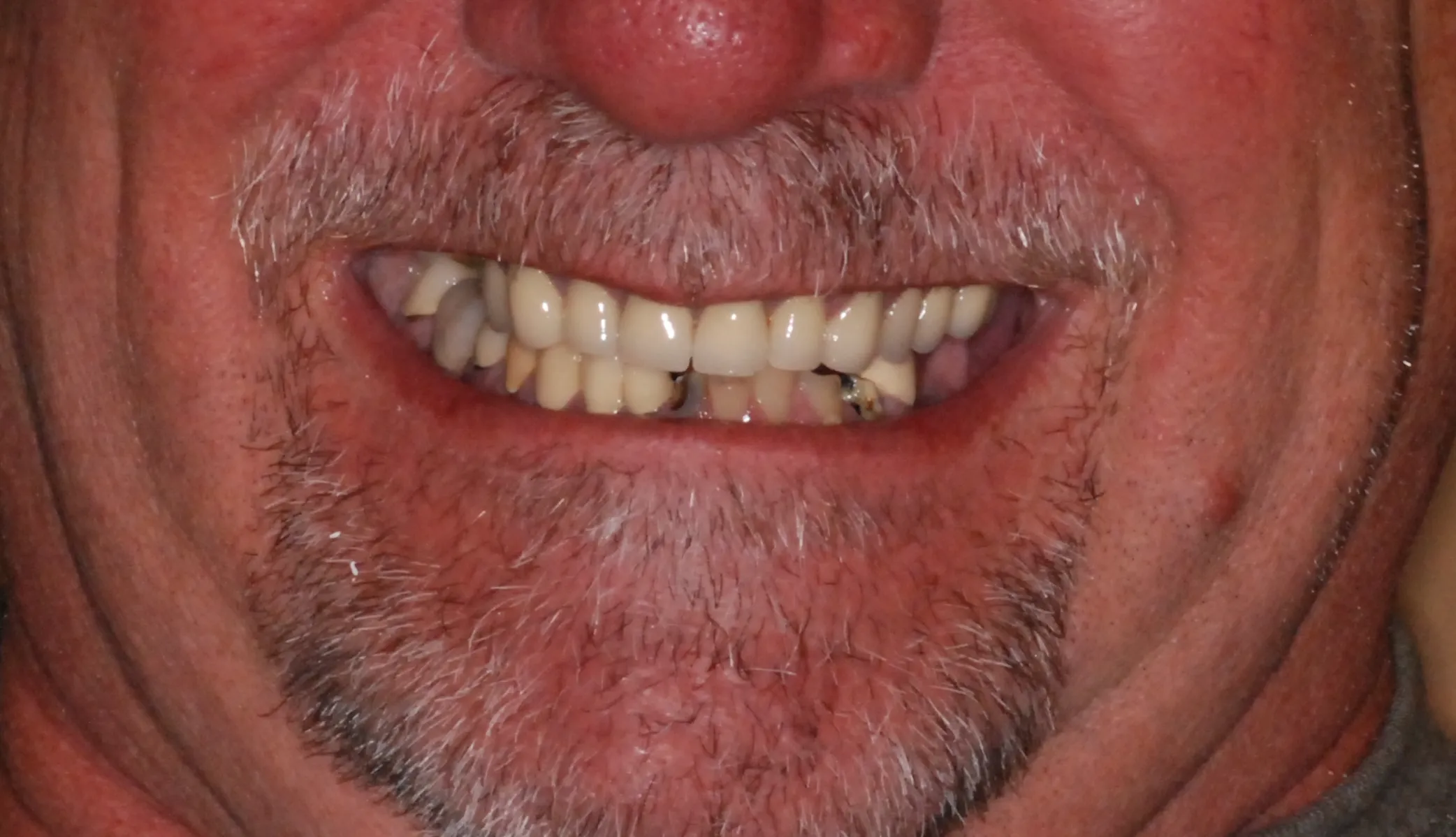 Dental Implant Smile Transformations