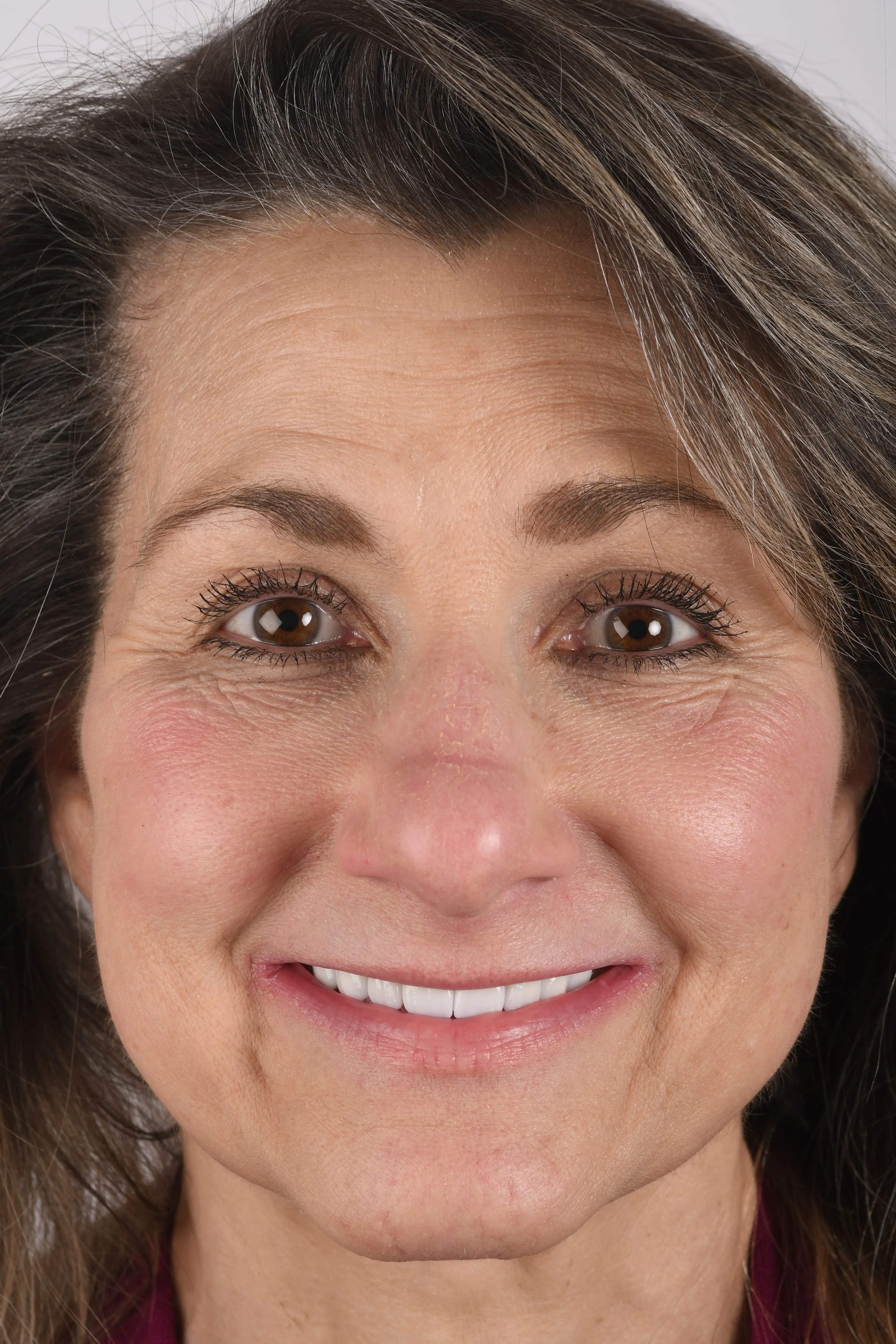 Dental Implant Smile Transformations