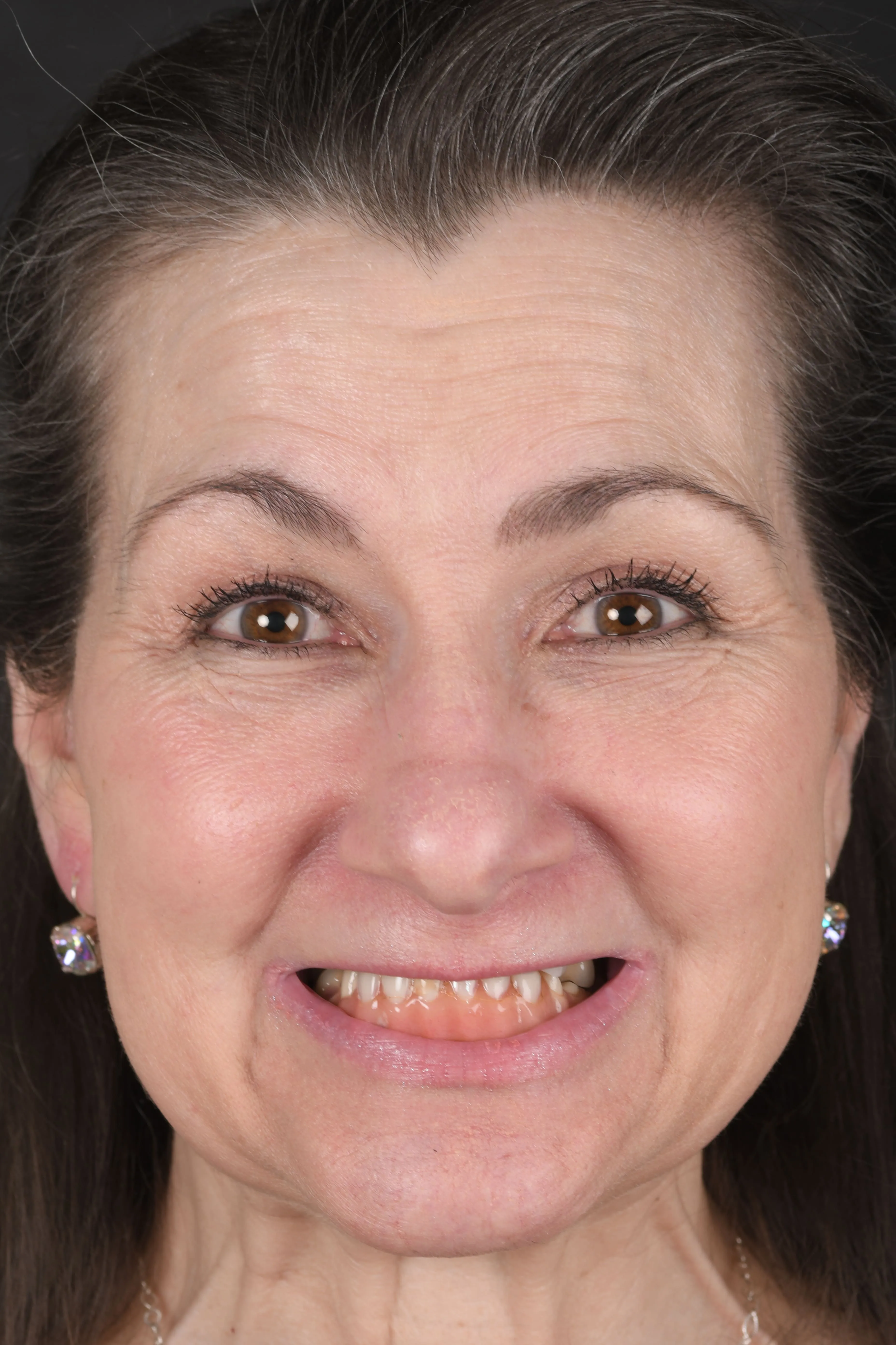 Dental Implant Smile Transformations