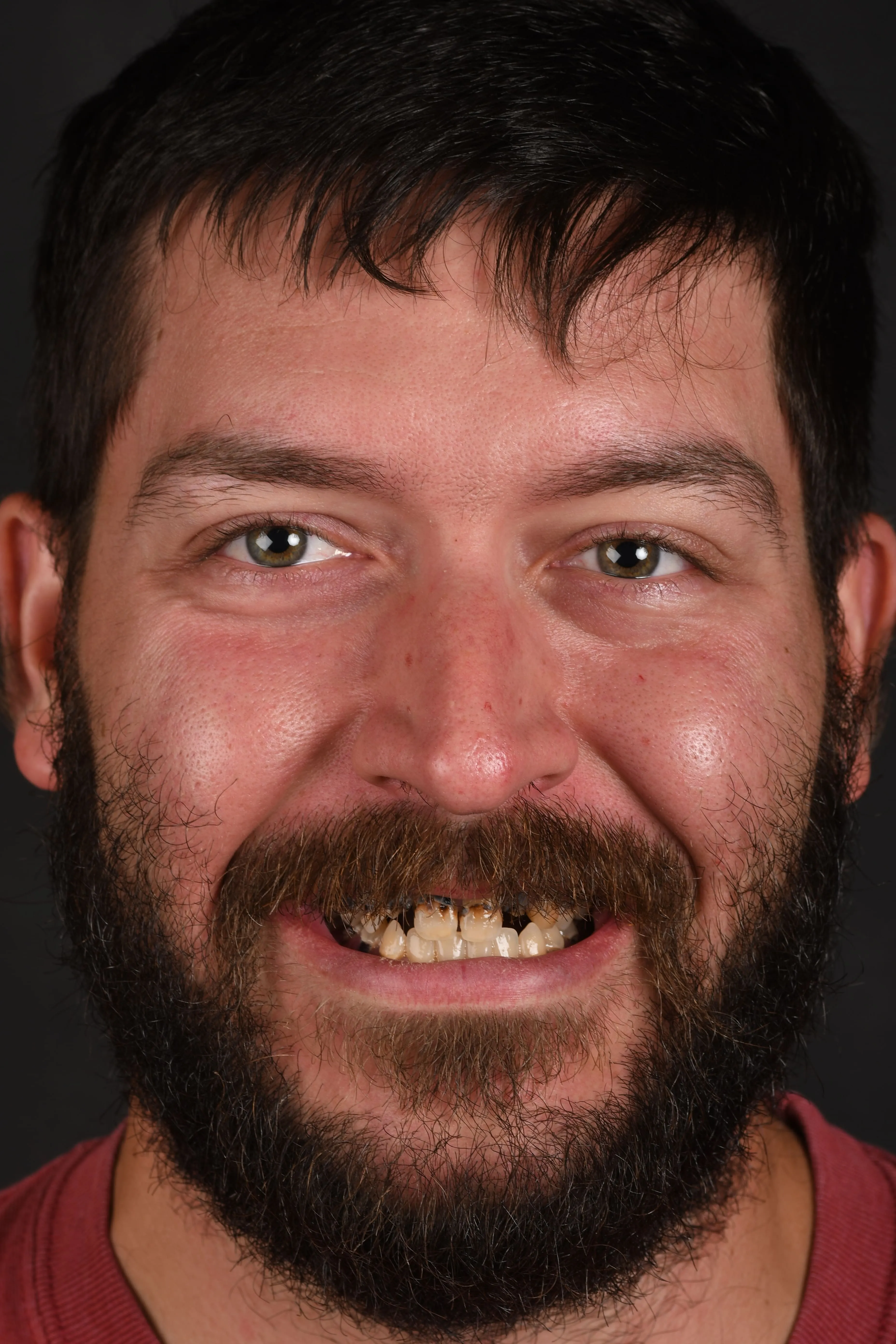 200+ 5 Star Google Reviews For Robotic Guided Dental Implants in Dallas