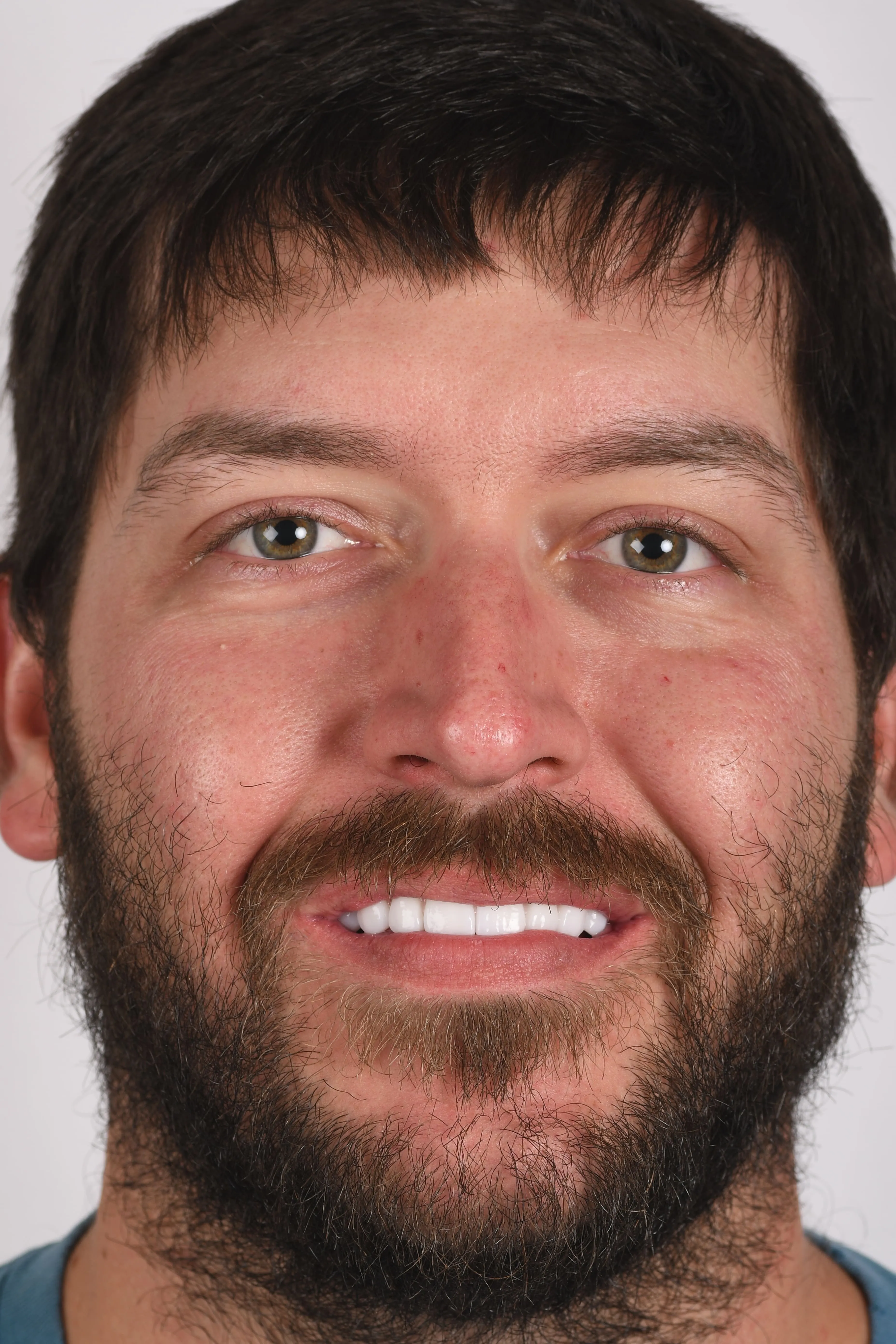 200+ 5 Star Google Reviews For Robotic Guided Dental Implants in Dallas