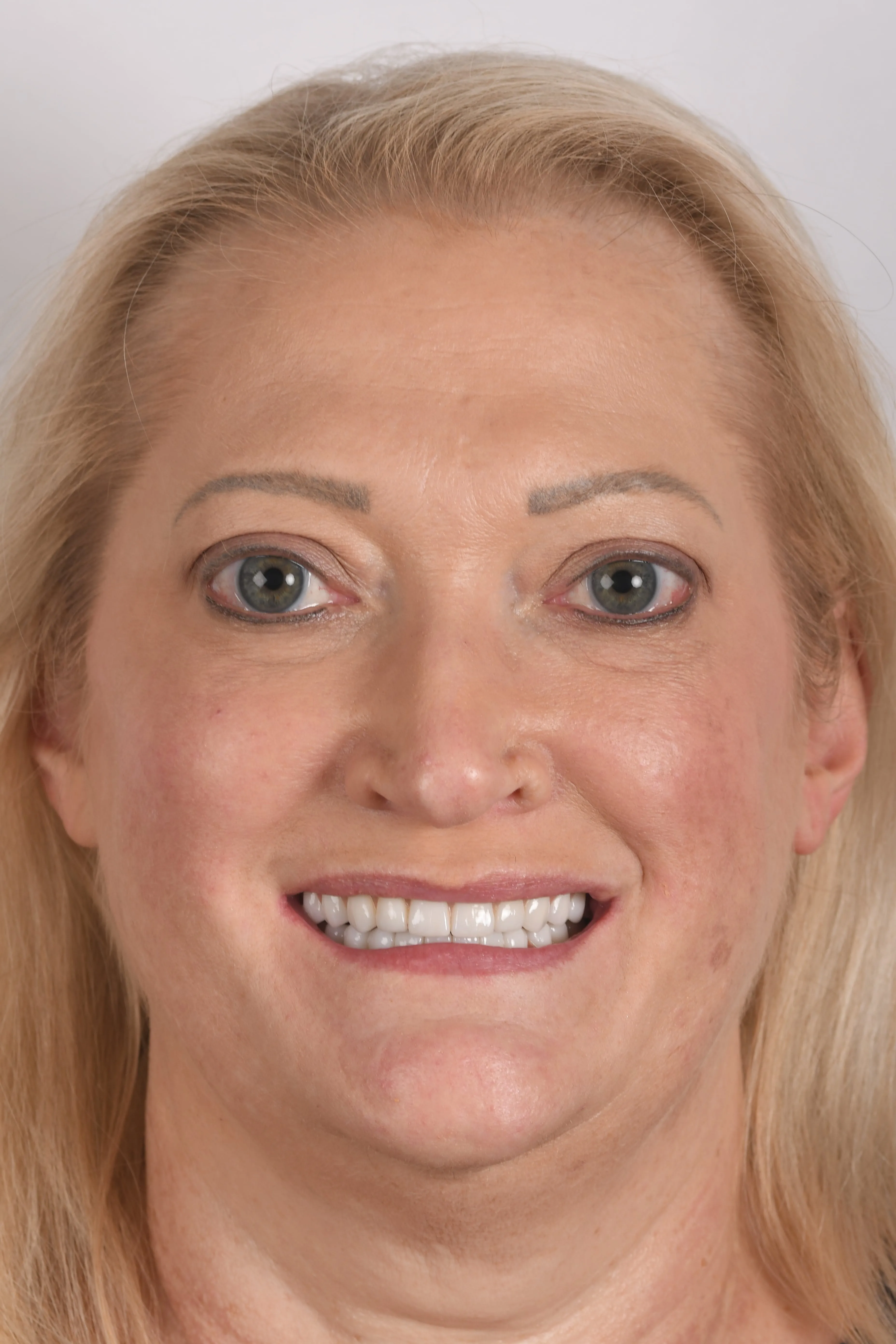 Dental Implant Smile Transformations