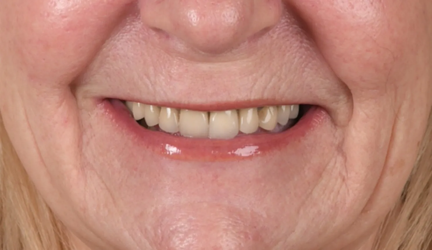 Dental Implant Smile Transformations