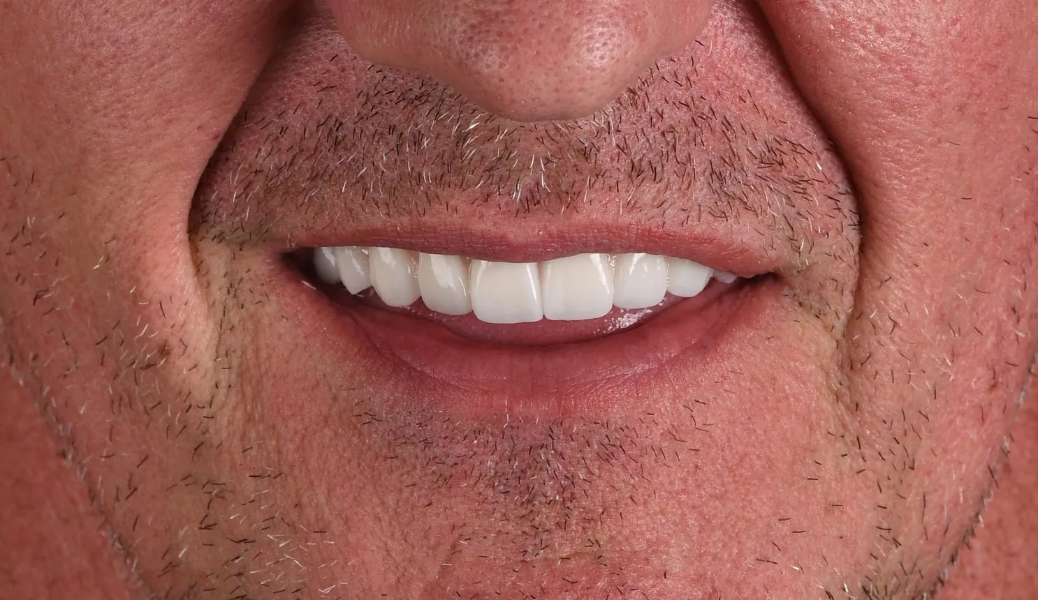 Dental Implant Smile Transformations