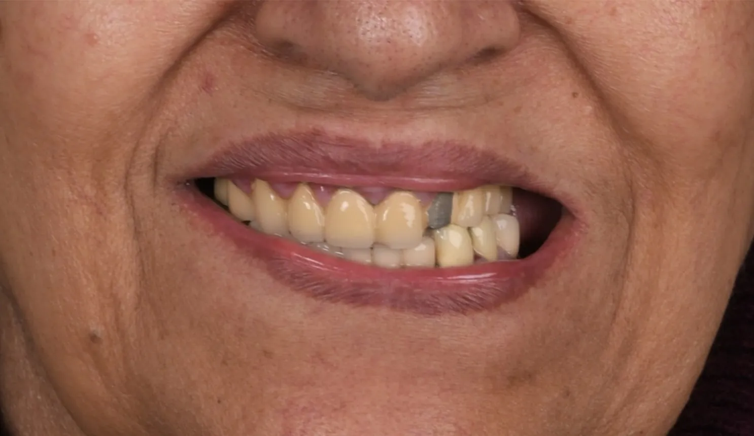 Dental Implant Smile Transformations