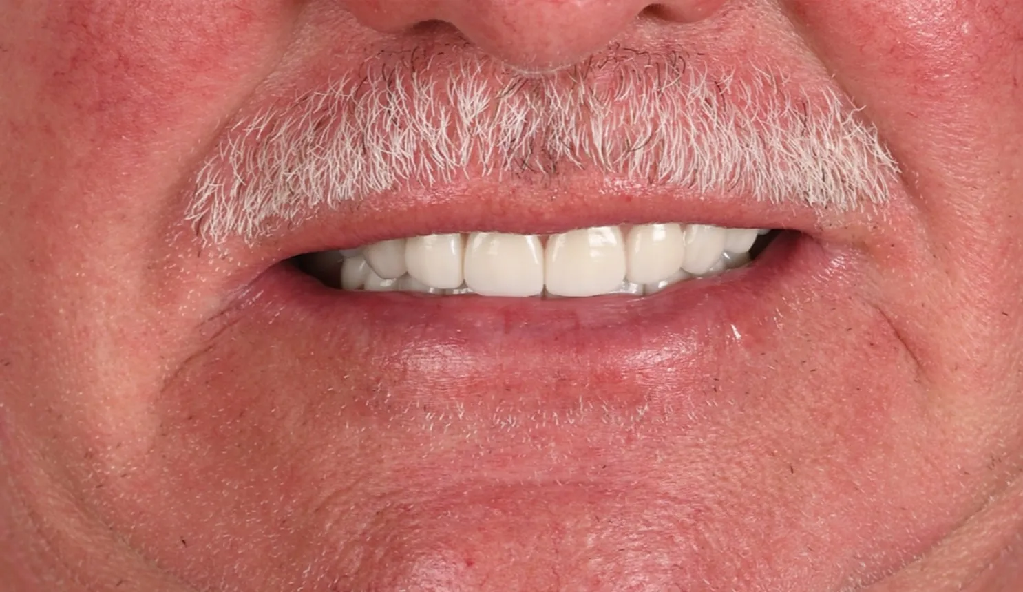 Dental Implant Smile Transformations