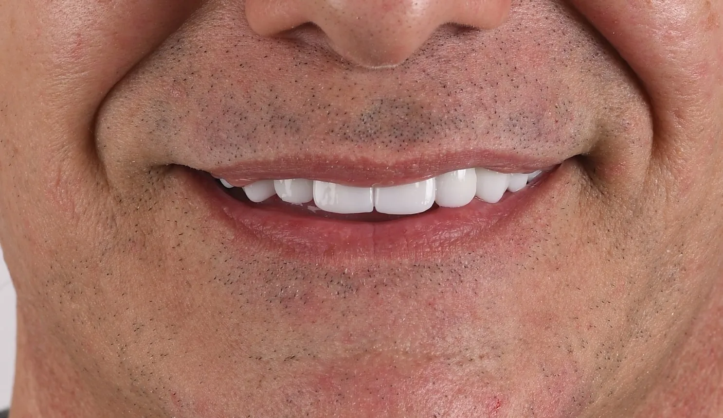 Dental Implant Smile Transformations