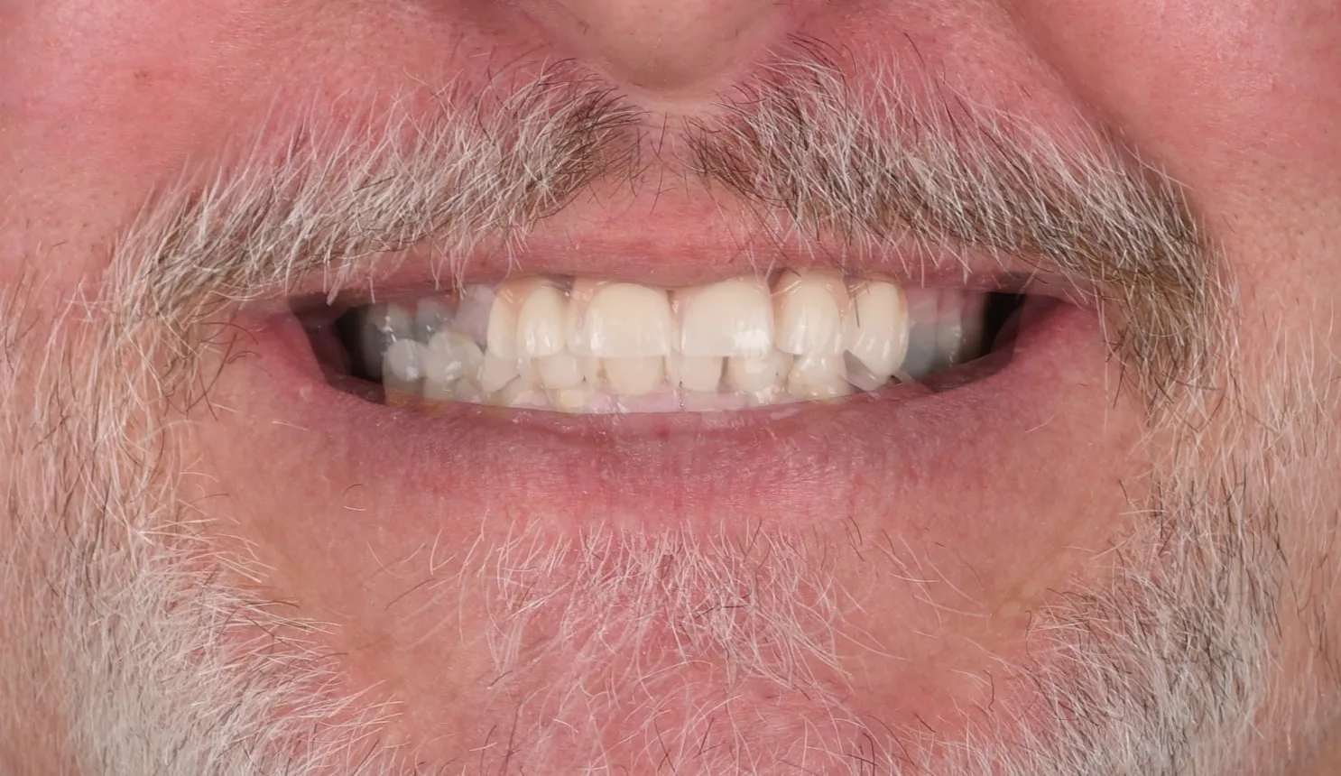 Dental Implant Smile Transformations