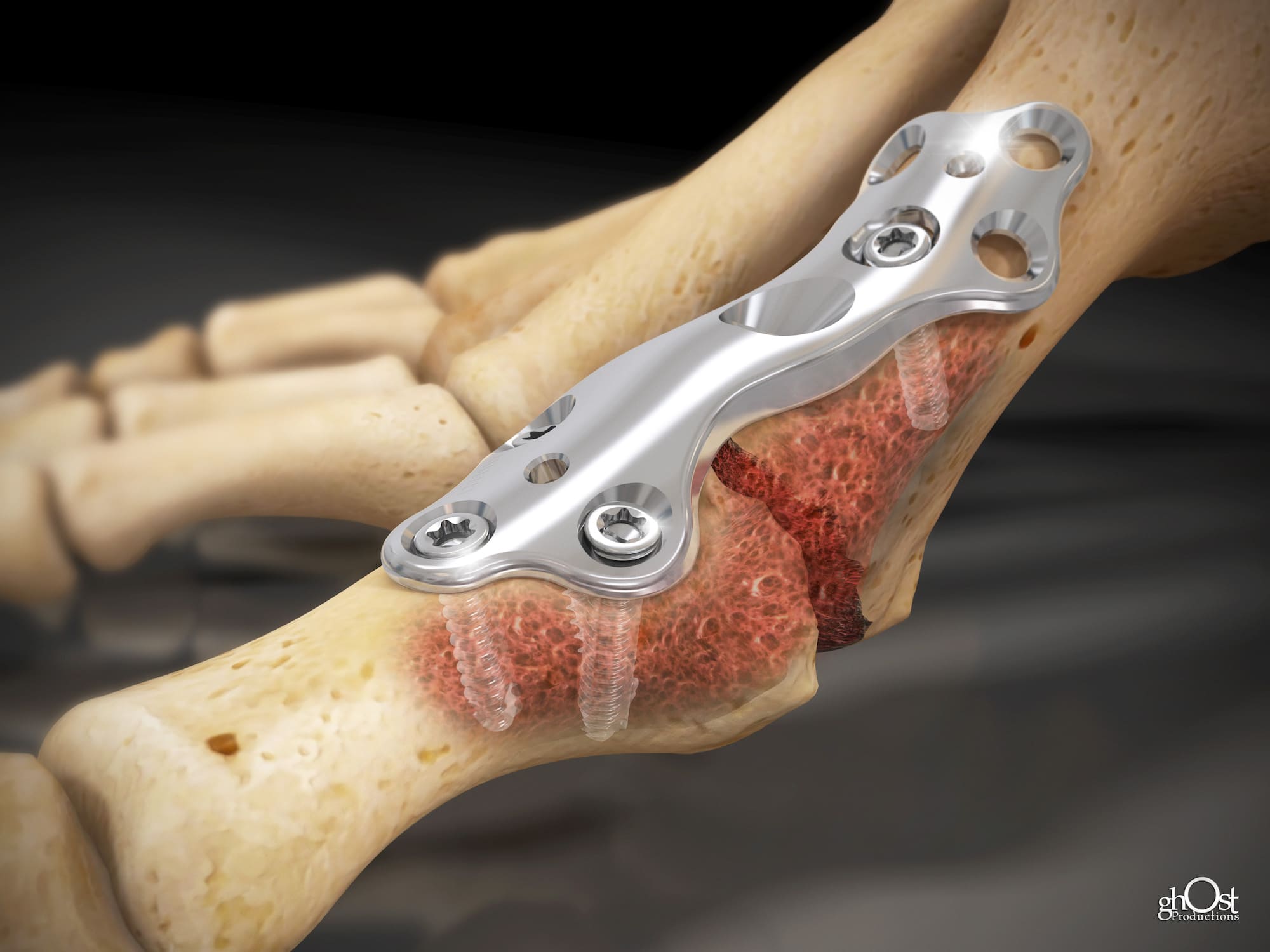 Osteomed Footplate device | Ghost Medical Images