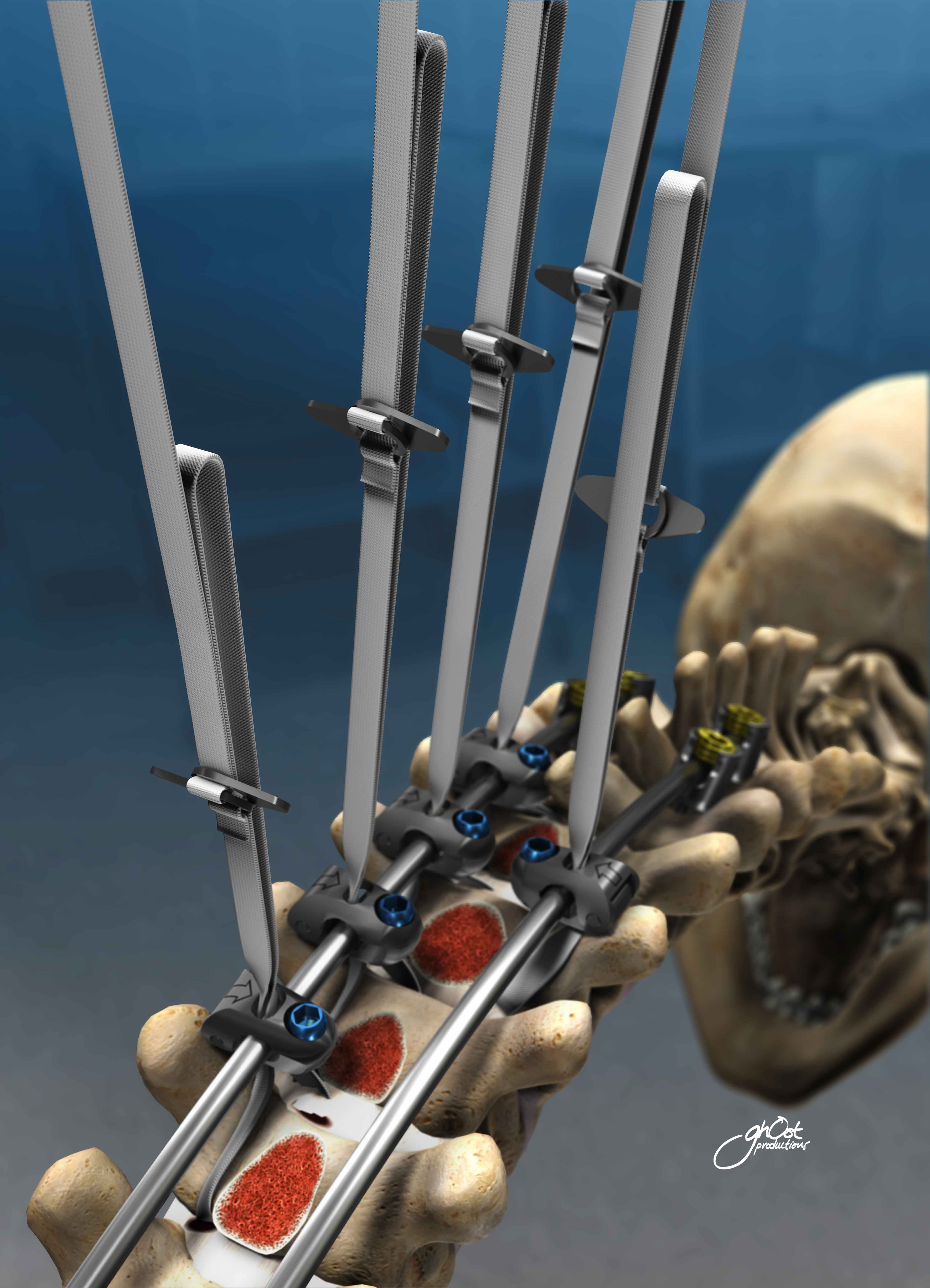 Zimmer Universal Clamp | Ghost Medical Images