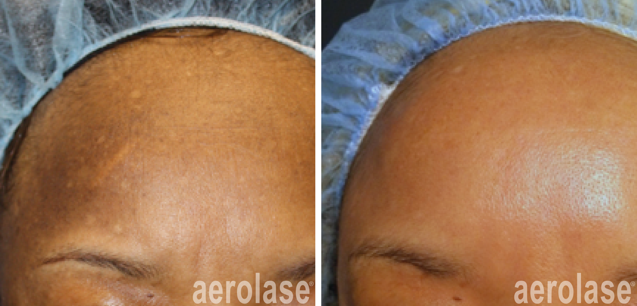 Aerolase NEO | Renual Medspa Myrtle Beach, SC