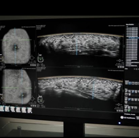 Early Detection of Breast Cancer: How Ultrasound Helps