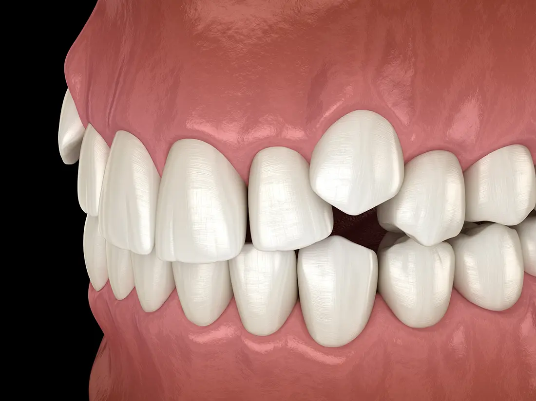 St. John Orthodontic Surgeries | St. John Oral Surgery and Dental Implants