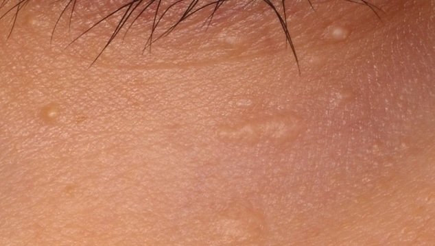 Skinea Montpellier | Les lésions de paupières (laser / chir)