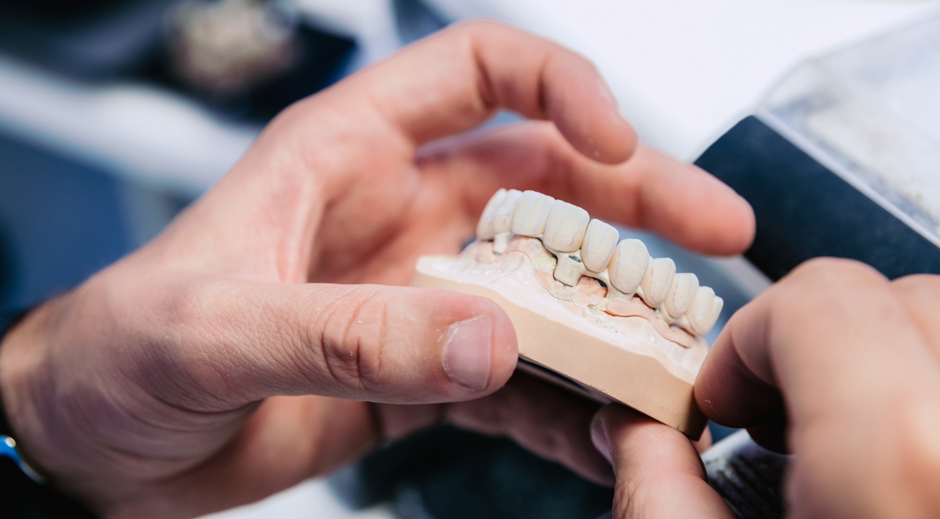 Protesi mobile e fissa | Odontotecnica Wind Brescia | Odontotecnica ...