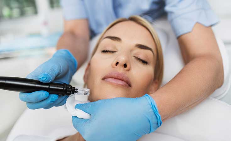 Microneedling with PRF