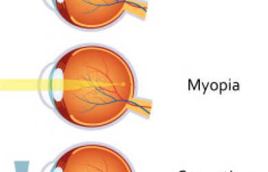 Myopia control | Tauranga Eye Care | Optometrist Tauranga | Eye Clinic