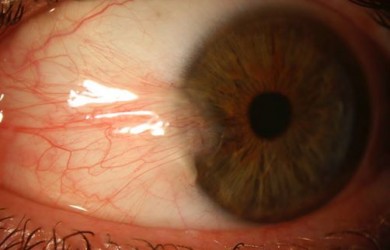 Pterygium | Tauranga Eye Care | Optometrist Tauranga | Eye Clinic