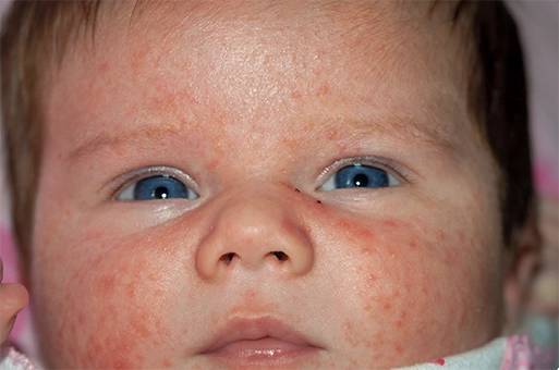 Understanding Common Newborn Rashes: A Paediatrician’s Guide for Parents