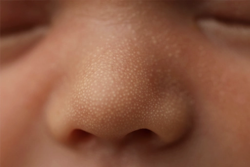 Understanding Common Newborn Rashes: A Paediatrician’s Guide for Parents