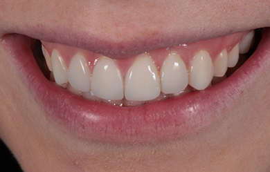 Tooth-coloured fillings in London | Discreet fillings at Fresh Dental ...