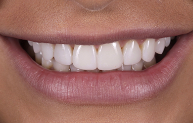 Invisalign in London | Invisalign teeth straightening at Fresh Dental ...